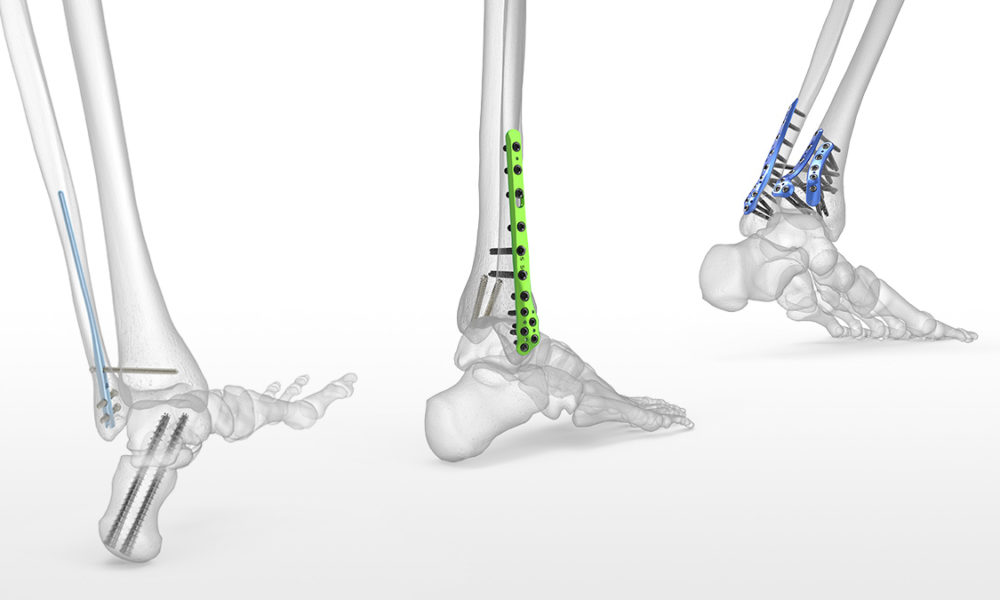 Use of Bone Screws in Internal Fixation - Quitalks.com